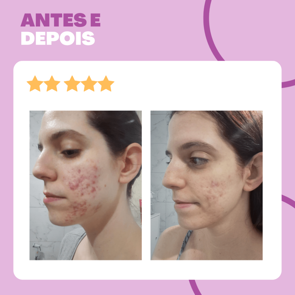 PROGRAMA VIVA SEM ACNE (VSA) – Dra Michele Pereira